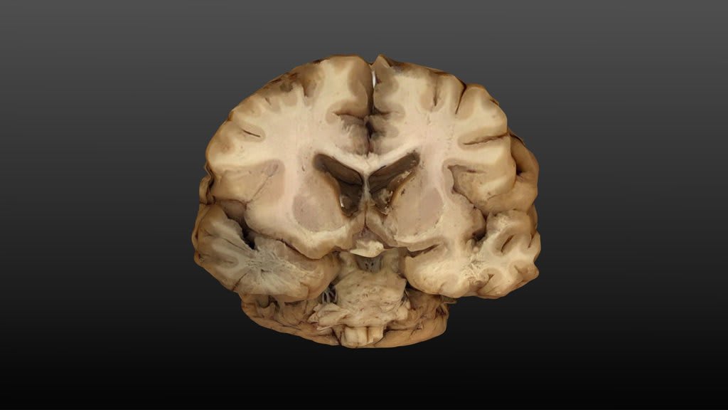 Cerebrum 3D | 3D Models | The Neurosurgical Atlas