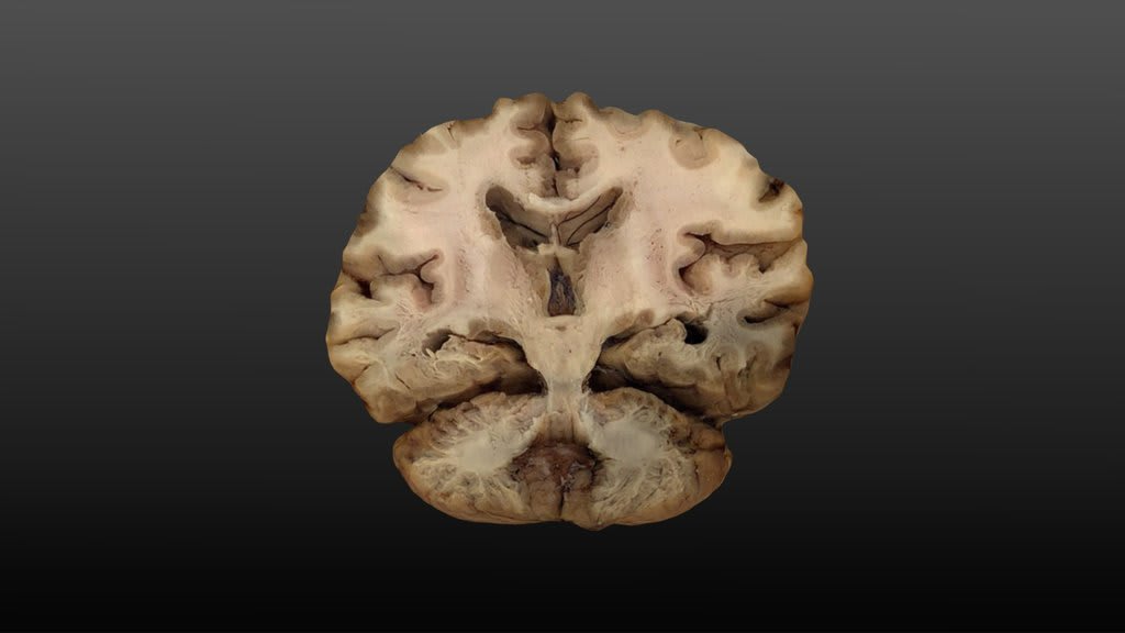 Cerebrum 3F | 3D Models | The Neurosurgical Atlas