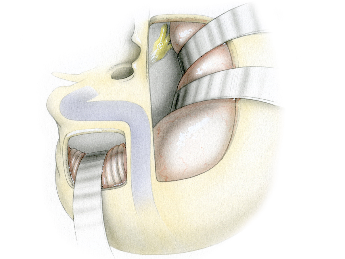 Combined Transpetrosal-Middle Fossa Approaches | Jackler Collection ...
