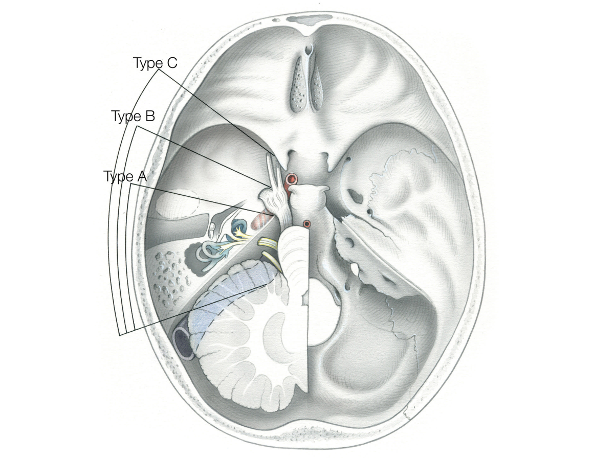 Infratemporal Fossa Approaches | Jackler Collection | Volumes | The ...