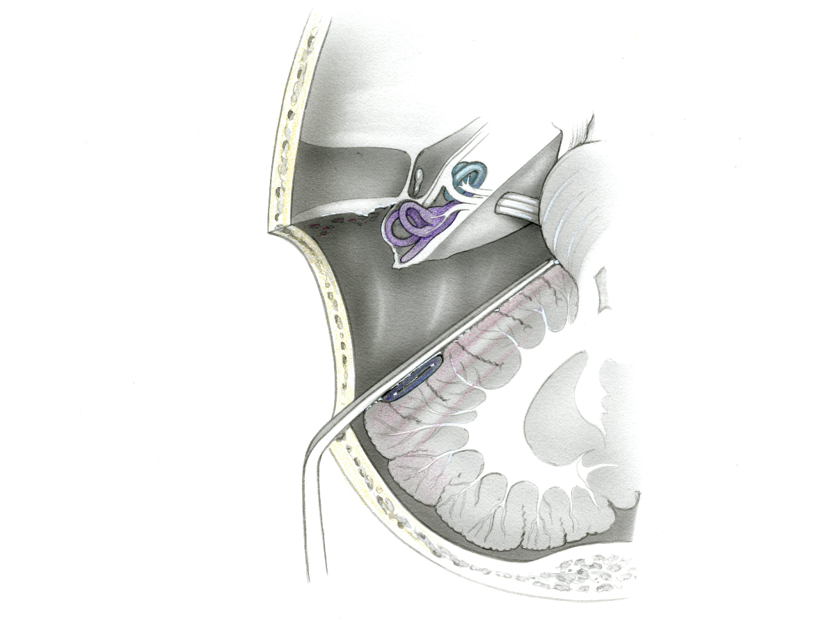 Retrolabyrinthine Approach | Jackler Collection | Volumes | The ...