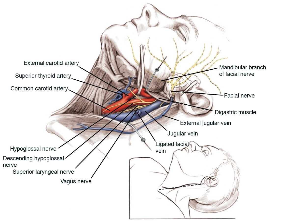 Extracranial Vascular Approaches | Meyer Collection | Volumes | The ...