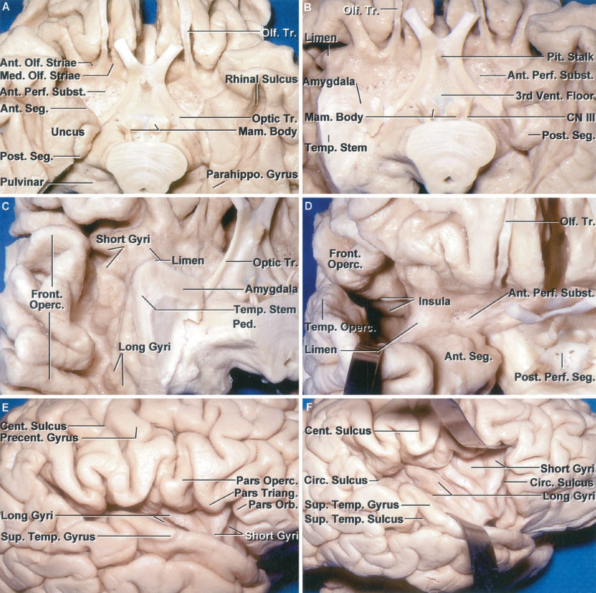 Anterior Perforated Substance and Sylvian Fissure | Neuroanatomy | The ...
