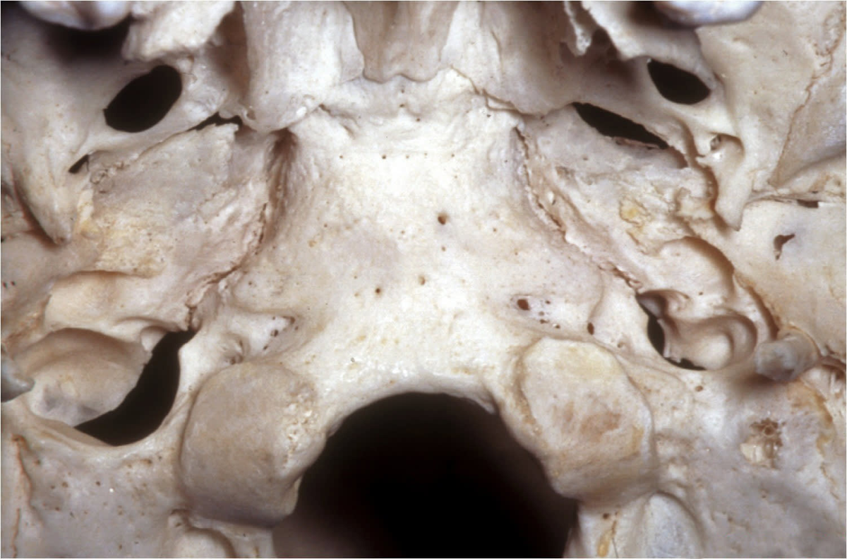 Anteroinferior View of Clivus Bony Anatomy | Neuroanatomy | The ...