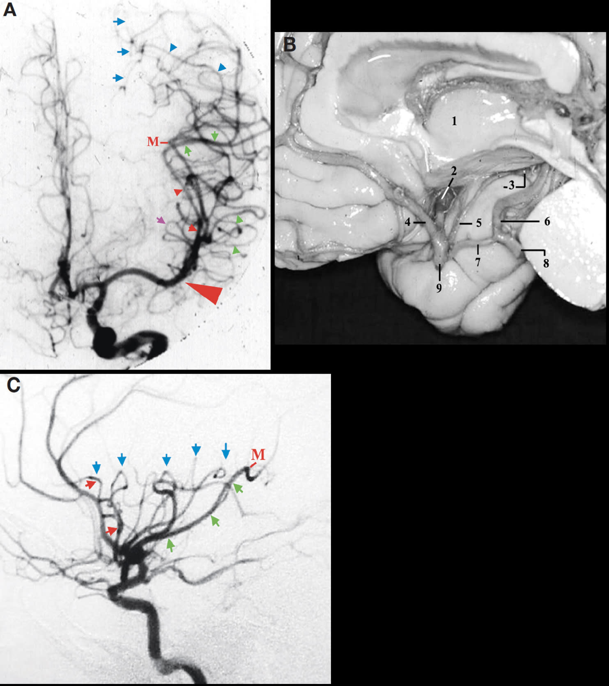 Carotid Angiography with Cadaveric Correlate | Neuroanatomy | The ...