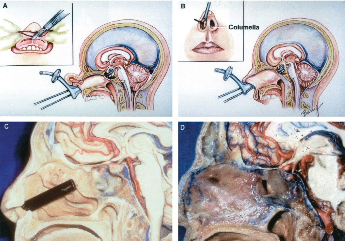 Combined Presigmoid and Far-Lateral Approach | Neuroanatomy | The ...