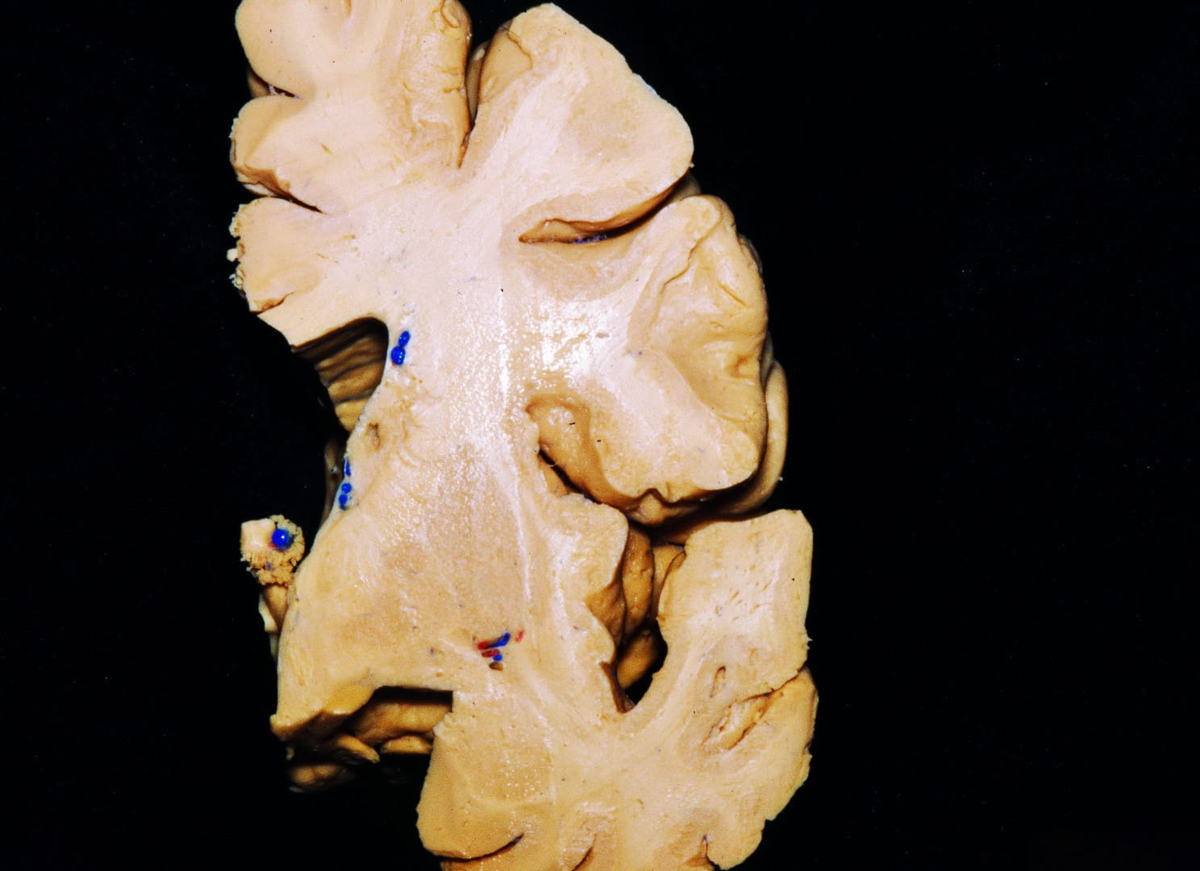 Coronal Section Across the Foramen of Monro and Apex of the Insula ...