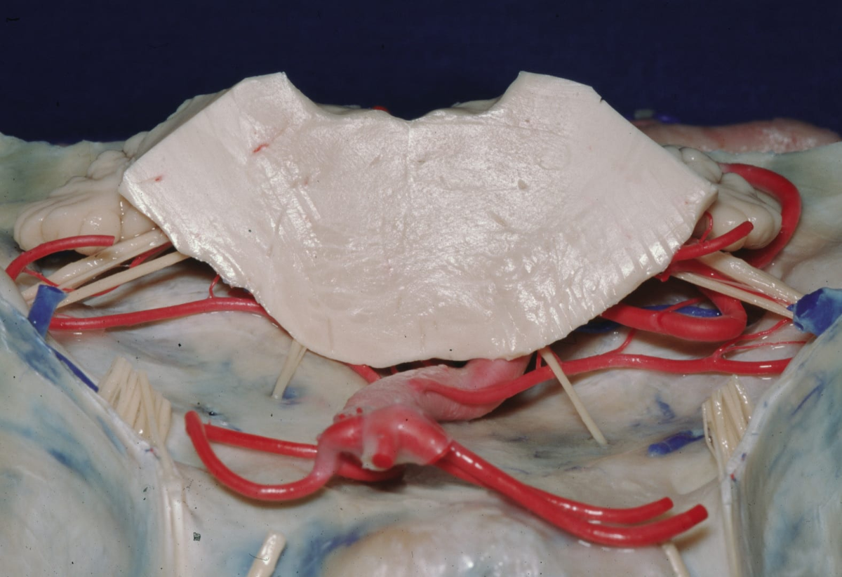 Cross-Section of the Posterior Fossa at the Level of the Pons ...