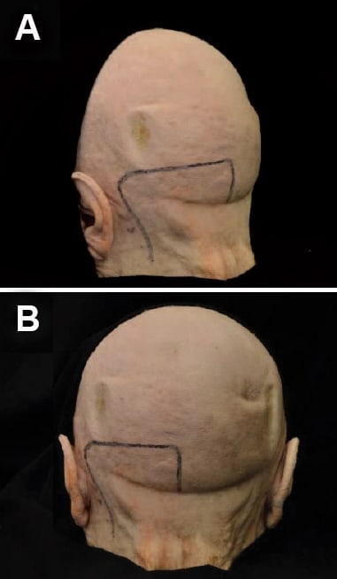 Cutaneous Incision for Far-Lateral Craniotomy | Neuroanatomy | The ...