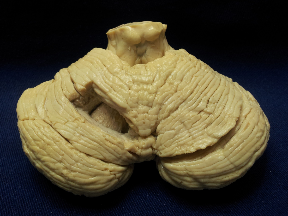 Dorsal View of the Midbrain and Superior Surface of the Cerebellum ...