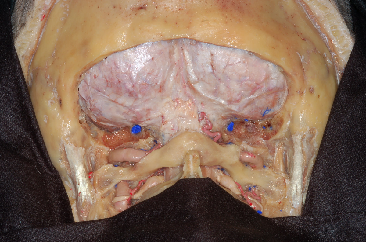 Dural Exposure of Posterior Cerebellum and Atlantic Part of the ...
