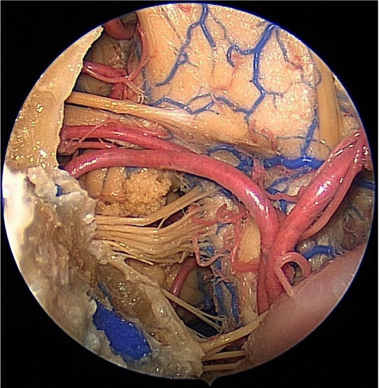 Endoscopic Middle and Lower Transclival Approach Intradural Exposure ...
