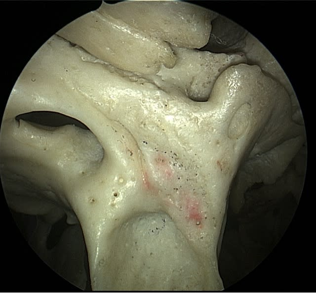 Endoscopic View of Pterygoid Process | Neuroanatomy | The Neurosurgical ...