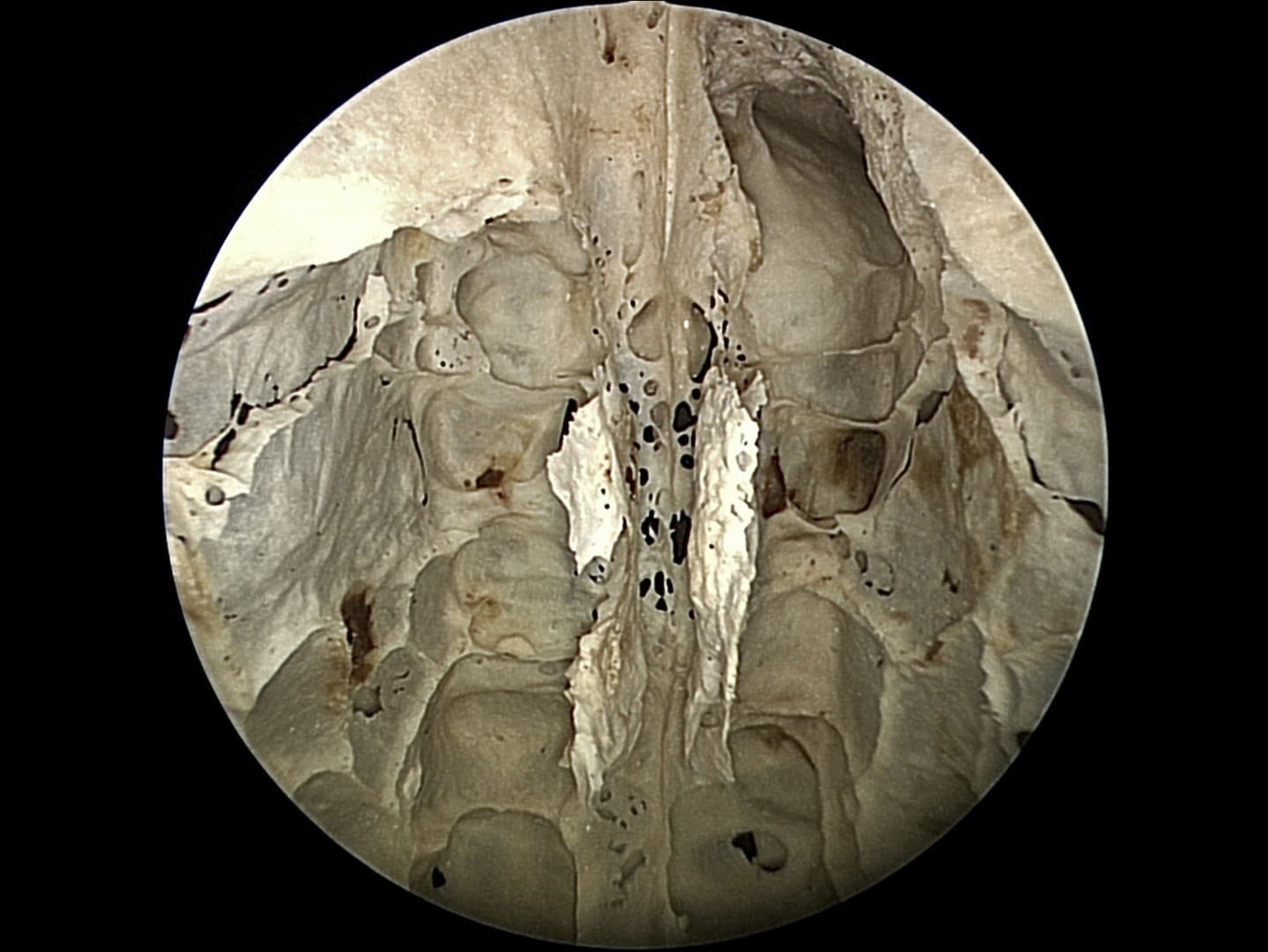 Inferior Endoscopic View of Ethmoid Bone Complex | Neuroanatomy | The ...