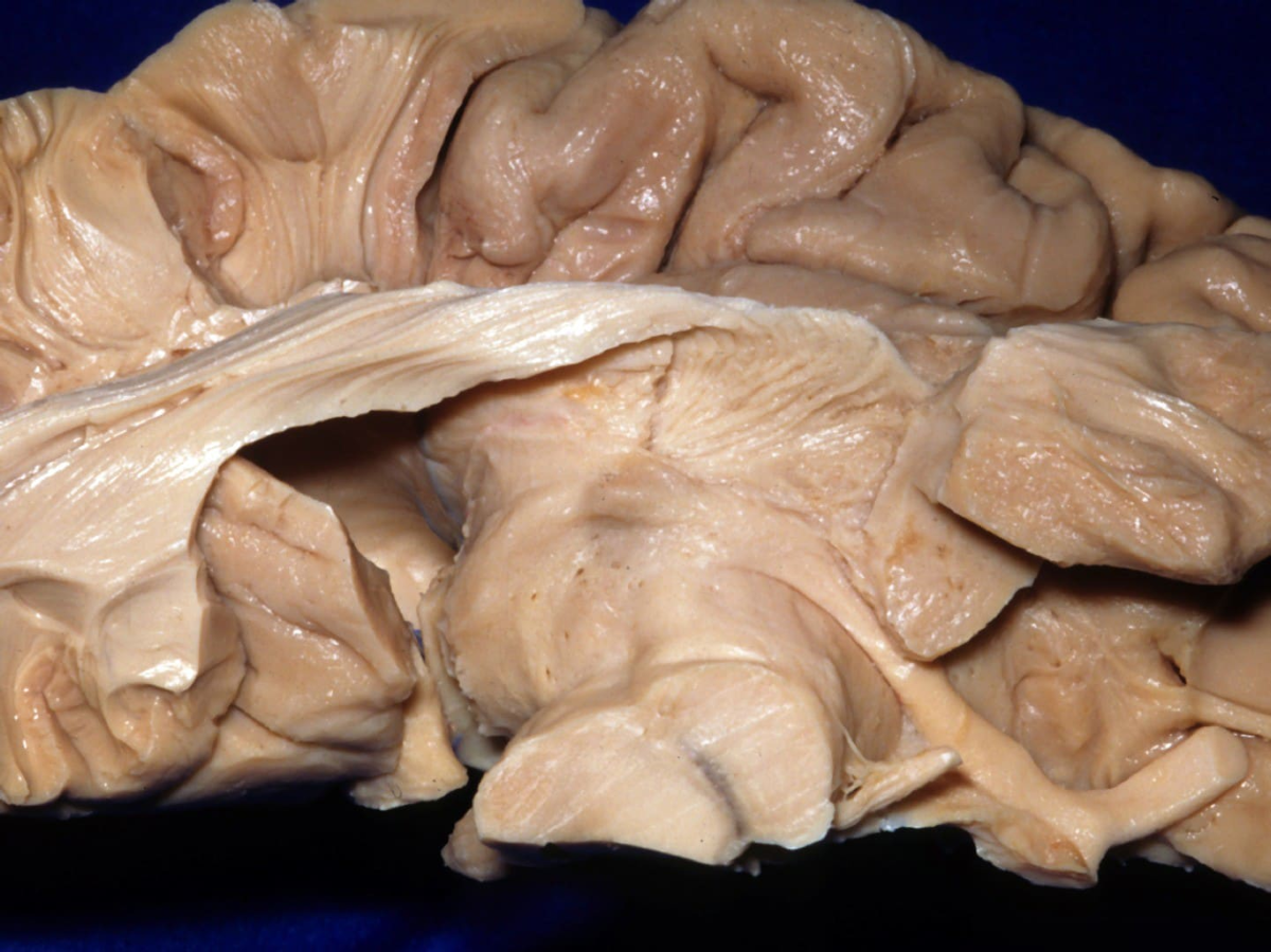 Inferior Perspective of Dissected Temporal Lobe | Neuroanatomy | The ...