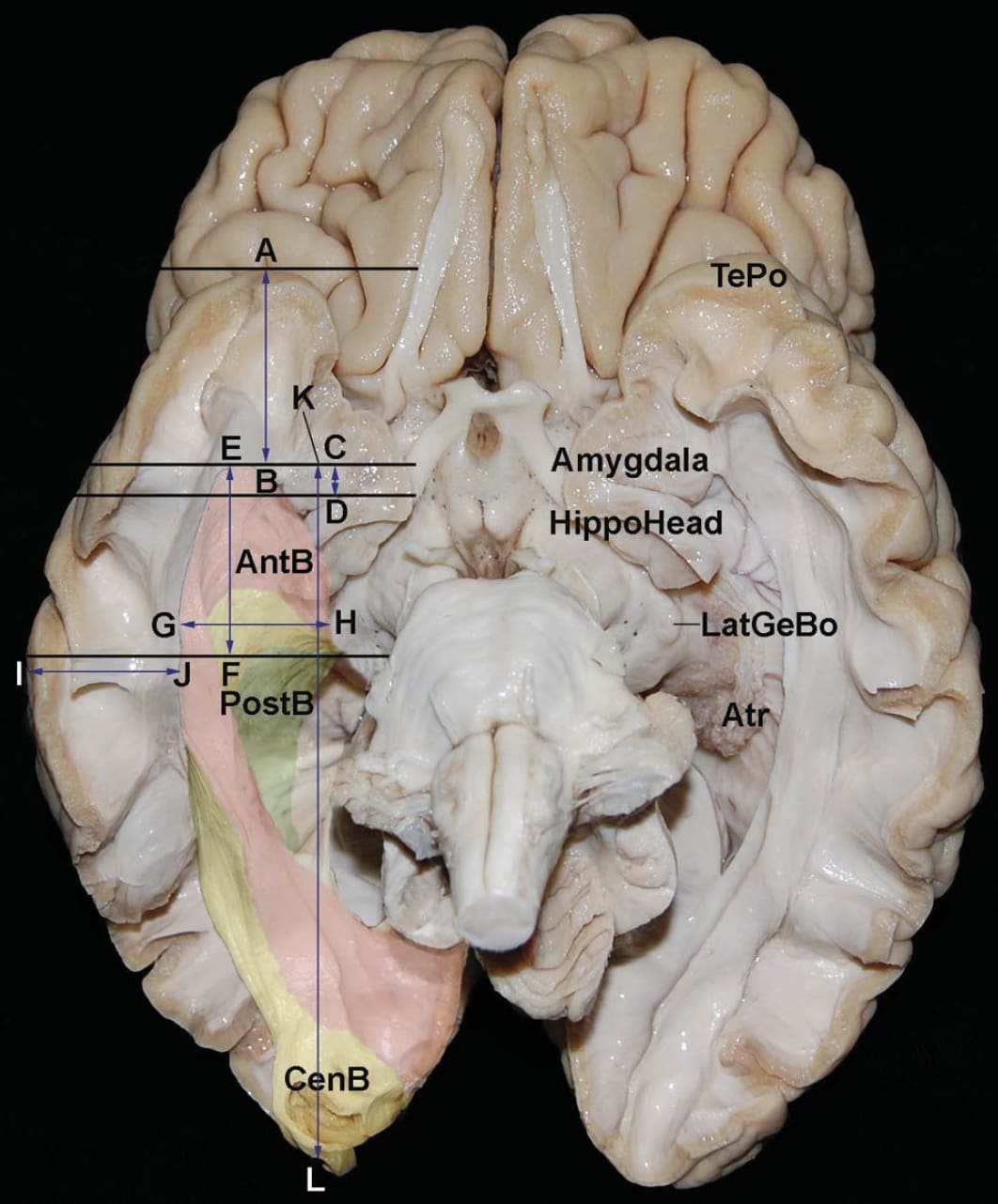 Inferior View of the Optic Radiation With Measurements | Neuroanatomy ...