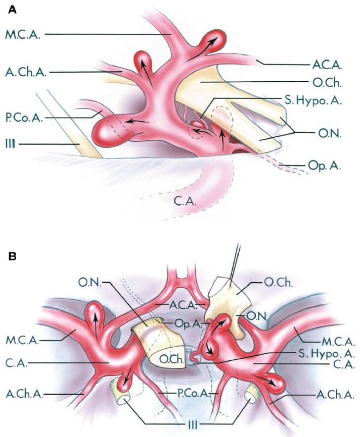 Lateral And Superior Views Of Common Aneurysm Sites On The Supraclinoid