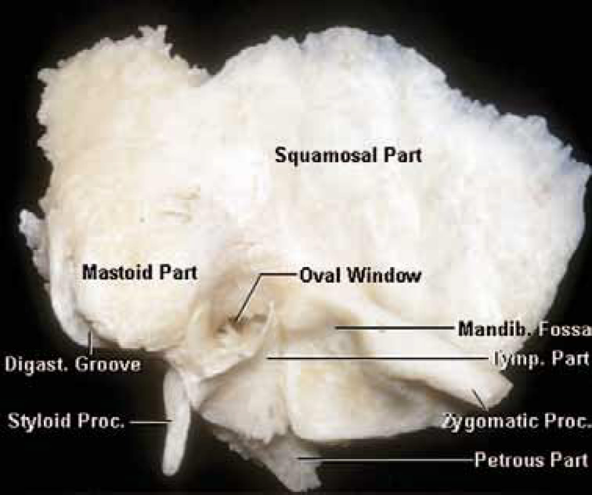 Lateral View of a Right Temporal Bone | Neuroanatomy | The ...