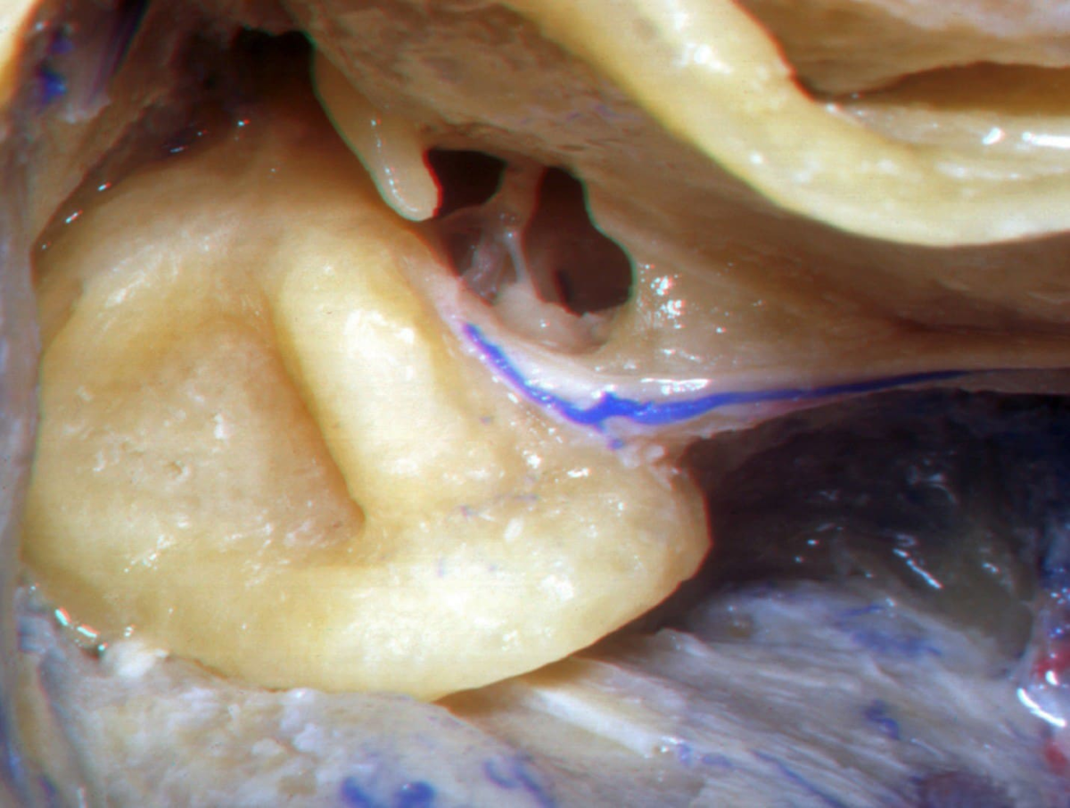 Lateral View of Bony Labyrinth | Neuroanatomy | The Neurosurgical Atlas