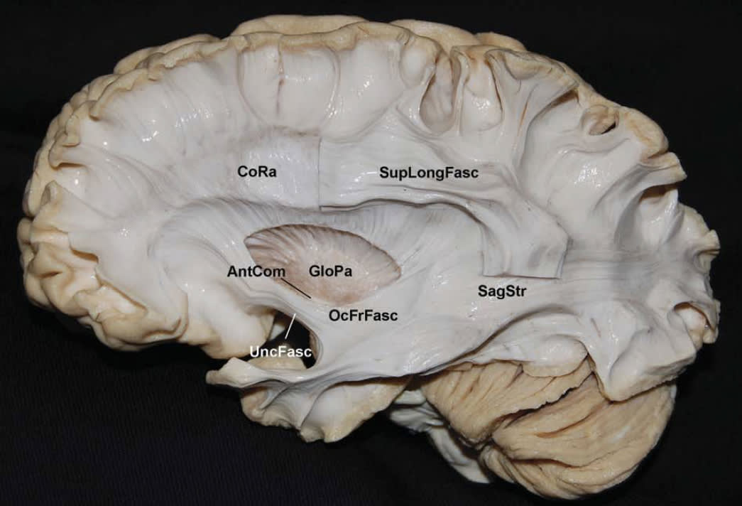 Lateral View of Left Hemisphere | Neuroanatomy | The Neurosurgical Atlas