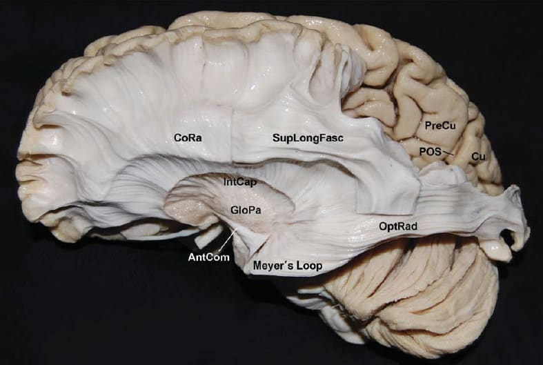 Lateral View of Left Hemisphere With the Vertical Segment of the ...