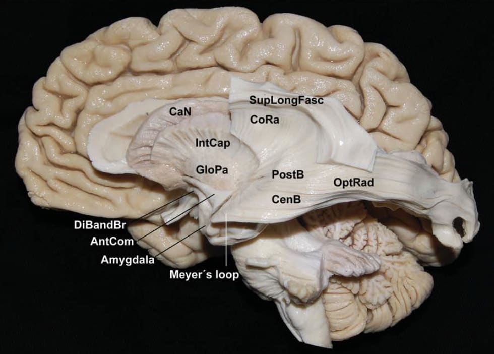 Lateral View of Optic Radiation of Left Hemisphere | Neuroanatomy | The ...