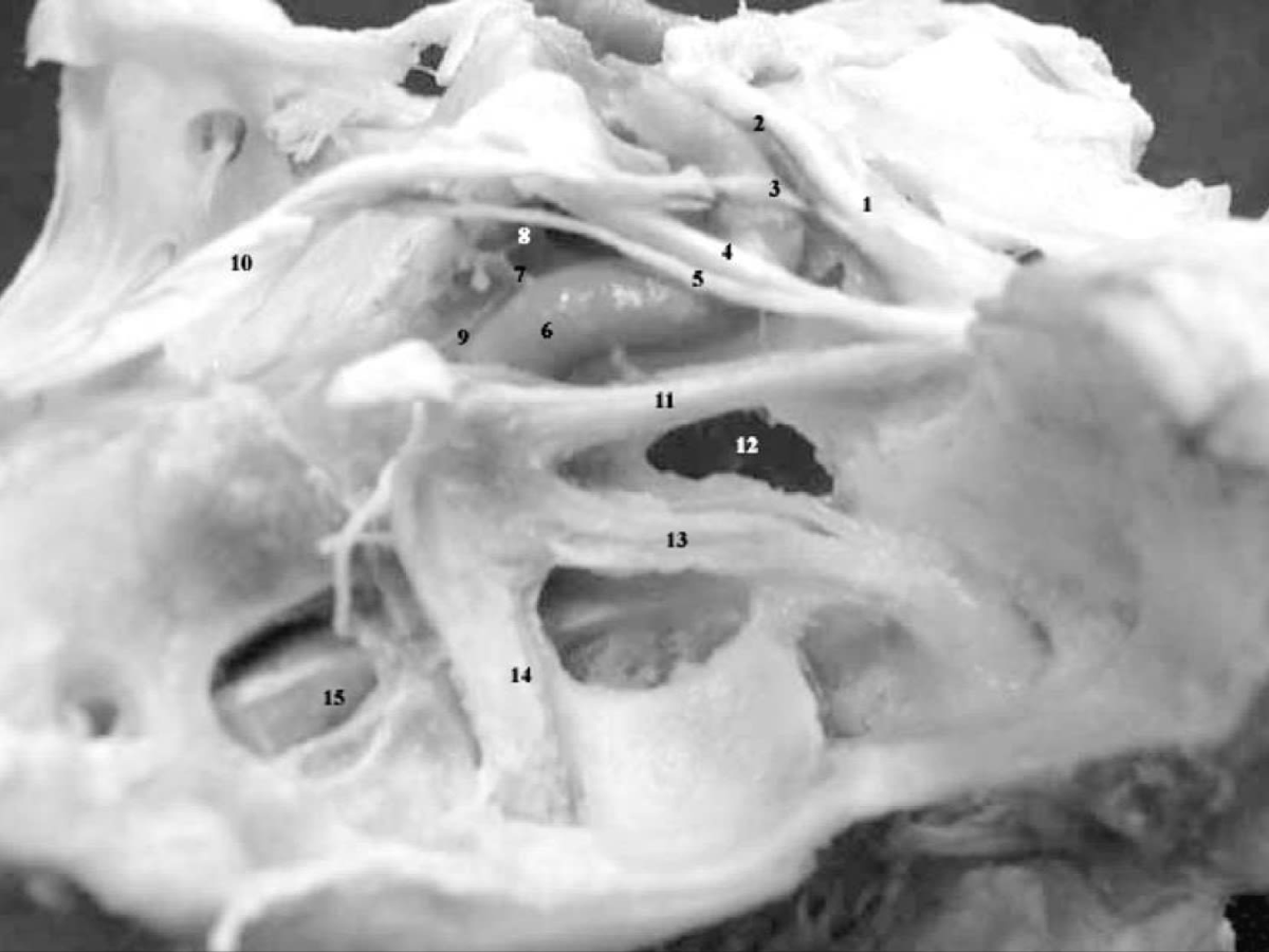 Lateral View of the Cavernous Sinus | Neuroanatomy | The Neurosurgical ...