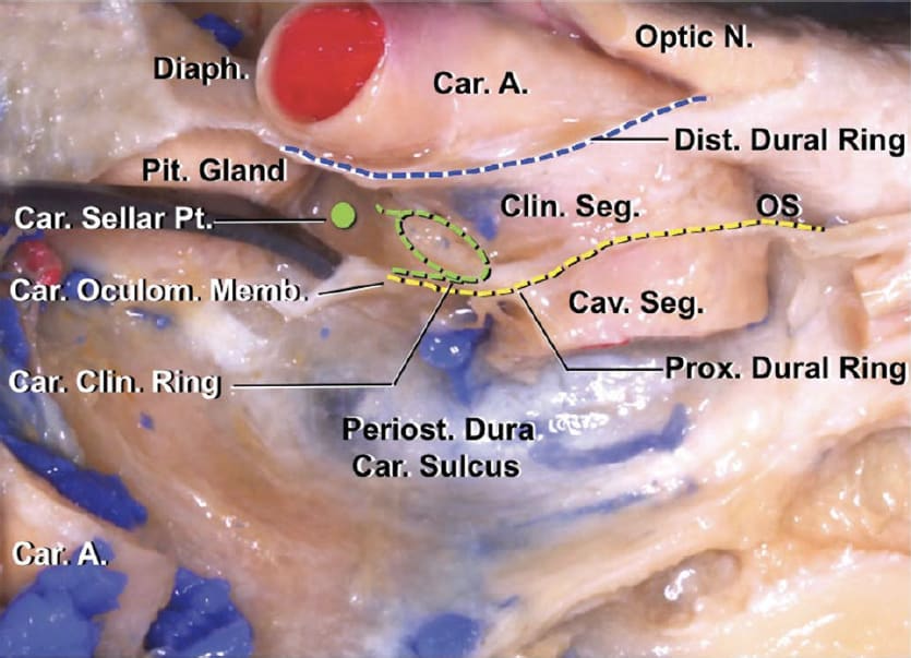 Lateral View of the Medial Wall of the Right Cavernous Sinus ...