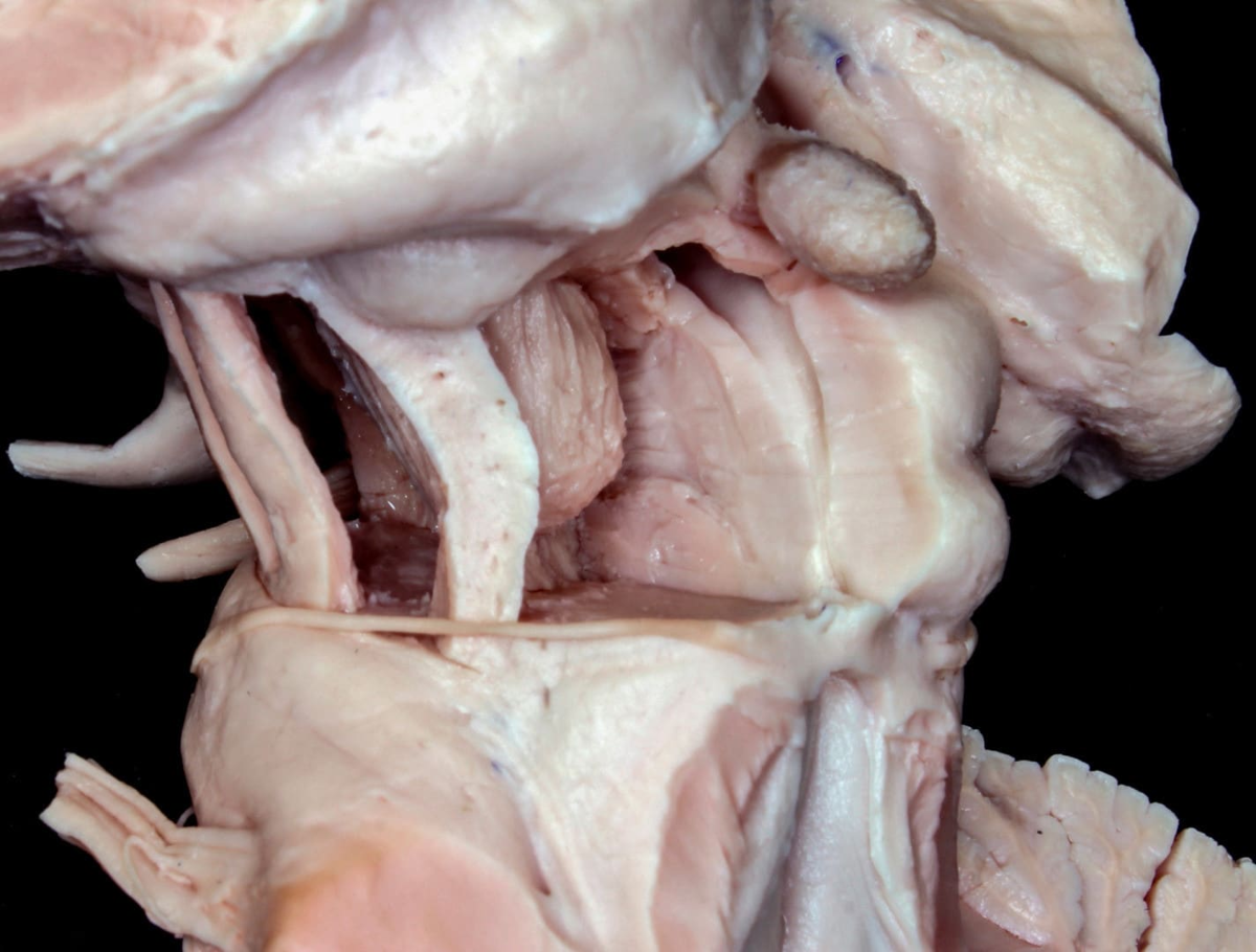 Lateral View of the Midbrain with Deep Structures Dissected ...