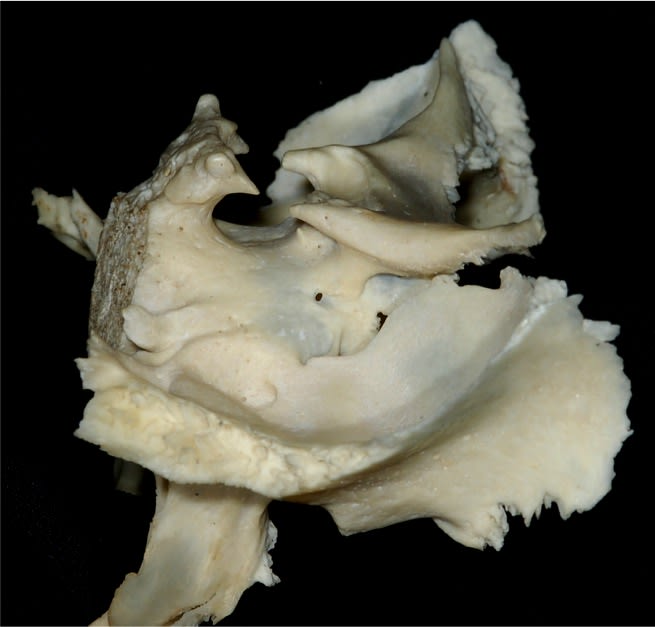 Lateral View of the Sphenoid Bone | Neuroanatomy | The Neurosurgical Atlas