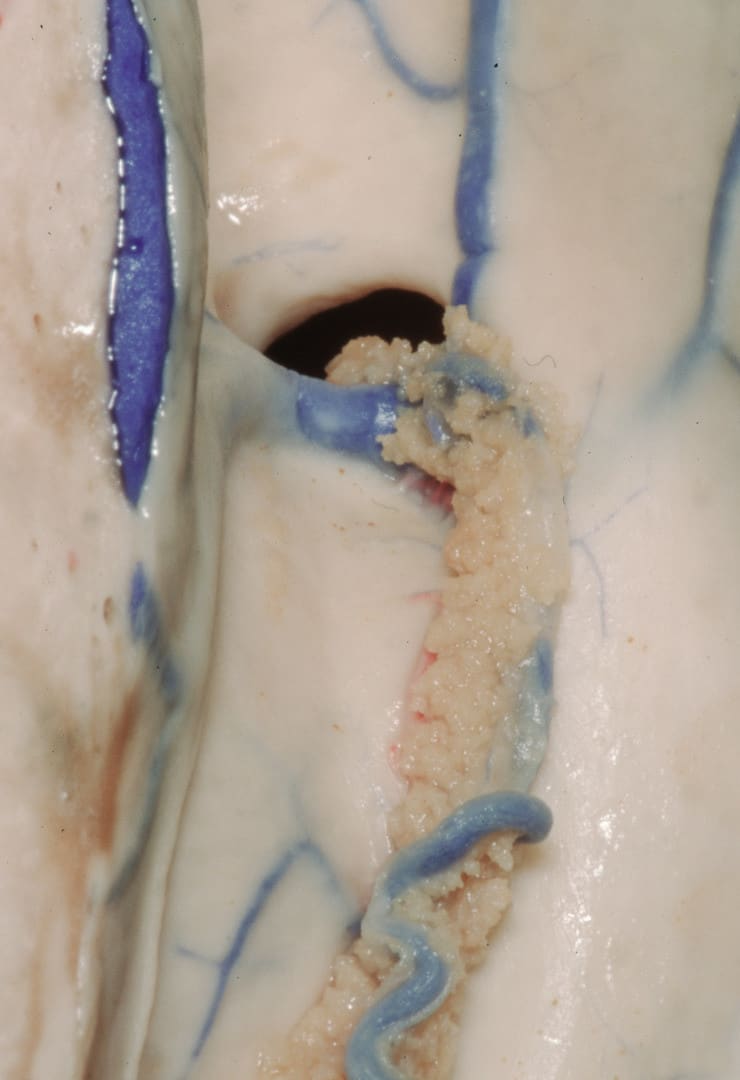 Left Interventricular Foramen of Monro | Neuroanatomy | The ...