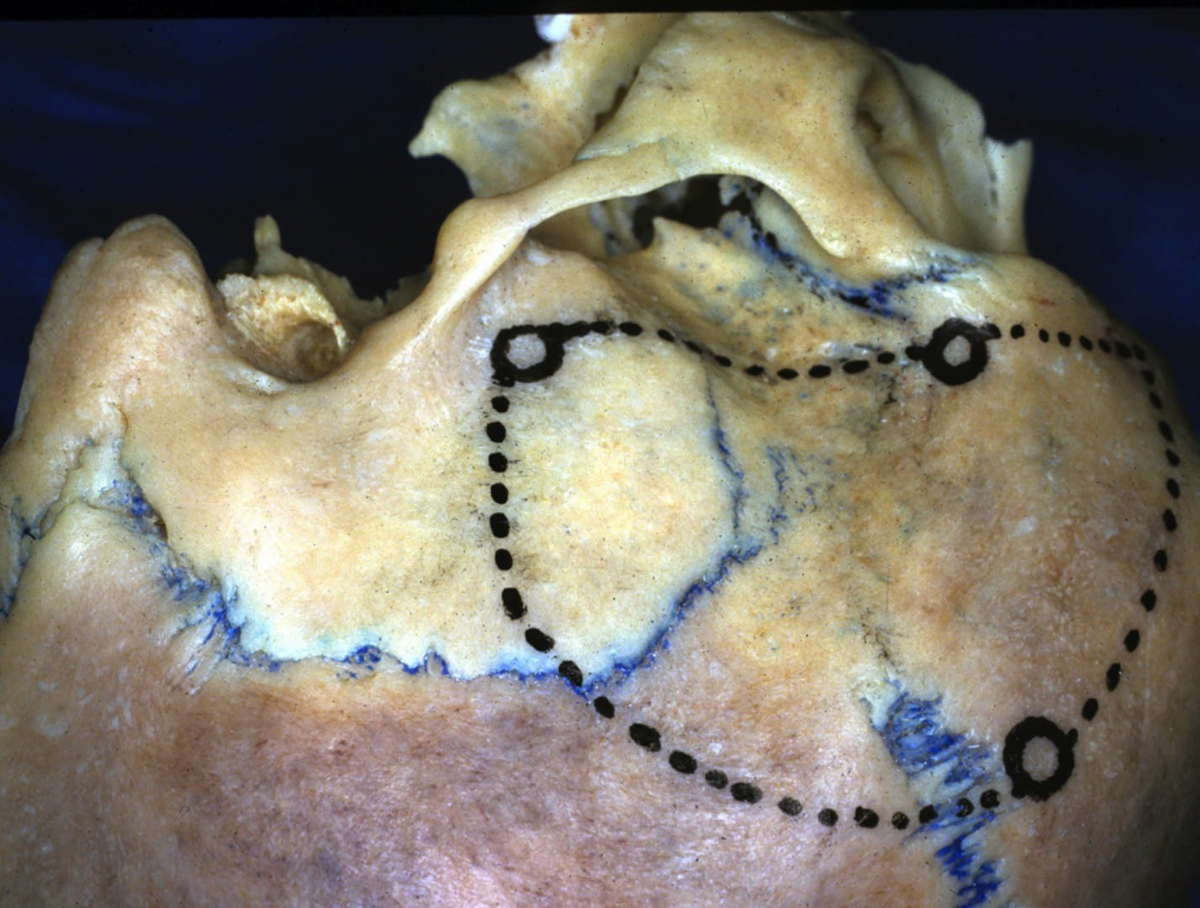 Left Lateral View of Skull | Neuroanatomy | The Neurosurgical Atlas