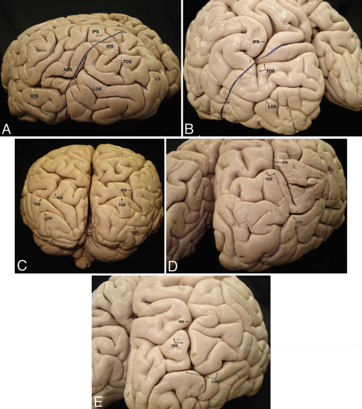 Left Occipital Lobe Convexity | Neuroanatomy | The Neurosurgical Atlas
