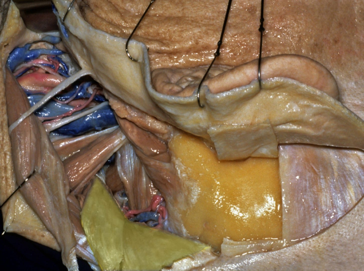 Left Posterolateral Exposure of the Mastoid Process | Neuroanatomy ...