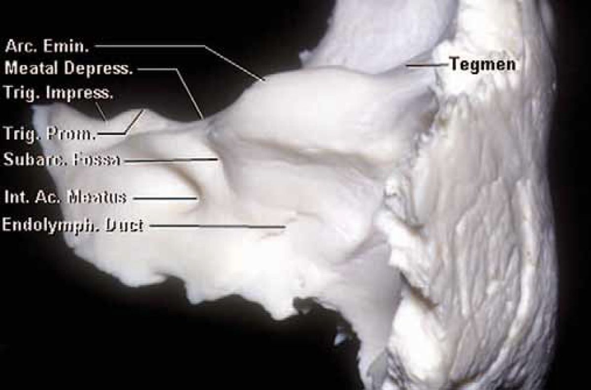 Magnified Posterior View of a Right Temporal Bone | Neuroanatomy | The ...