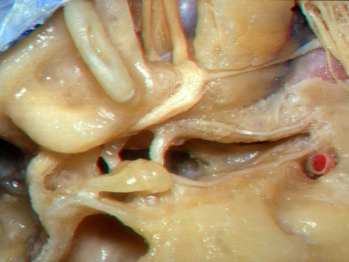 Magnified Right Superior View of IAC, Inner and Middle Ear, and EAC ...