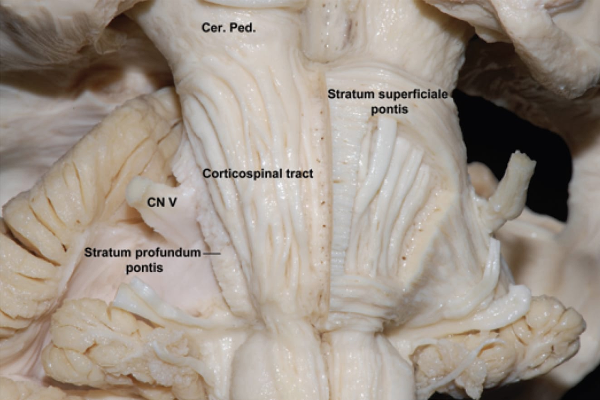 Magnified View, at the Level of the Pons | Neuroanatomy | The ...