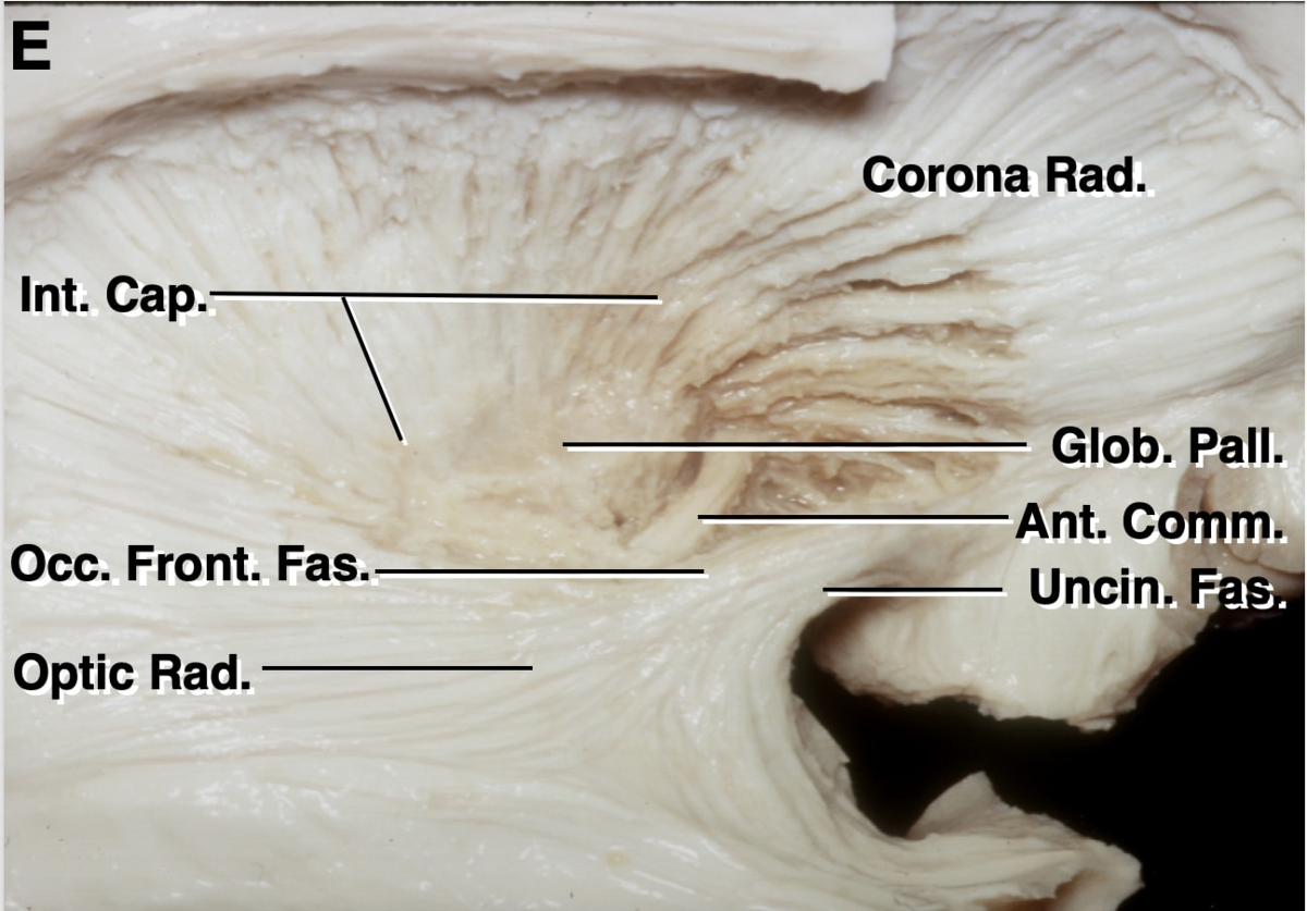 Magnified View of Deep White Matter Tracts Around the Globus Pallidus ...
