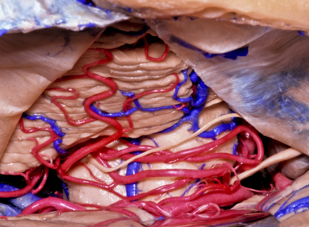 Magnified View of Left Lateral Subtemporal Area with Tentorium and ...