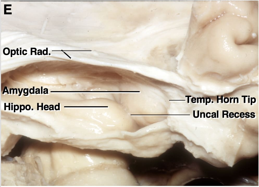 Magnified View of the Temporal Horn | Neuroanatomy | The Neurosurgical ...