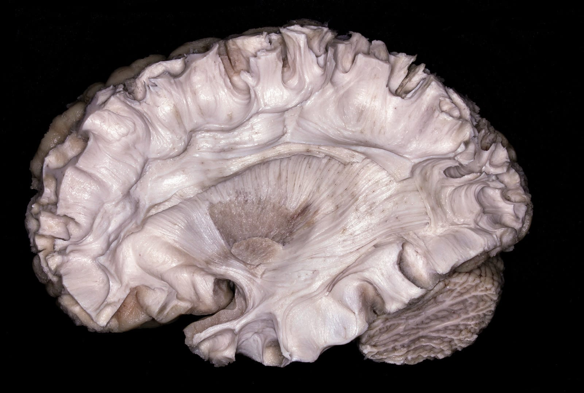 Major White Matter Tracts of the Cerebral Hemisphere | Neuroanatomy ...