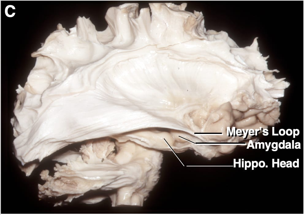 Meyer’s Loop, Hippocampus and Amygdala | Neuroanatomy | The ...