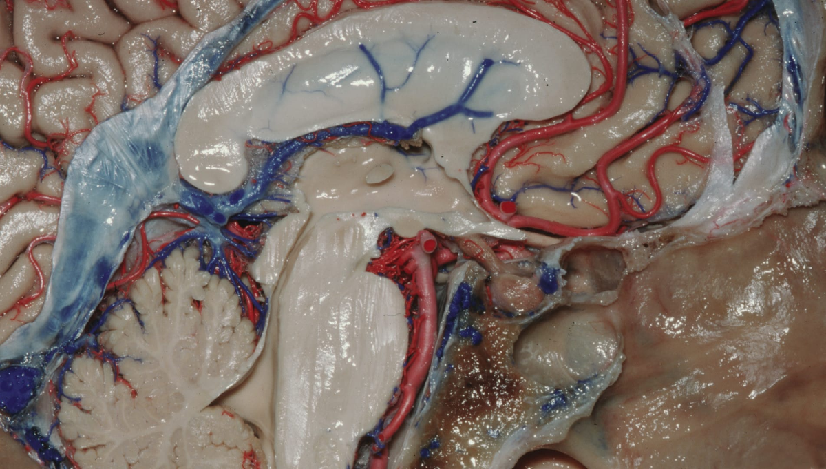 Mid-Sagittal View of the Brain and Ventricular System | Neuroanatomy ...