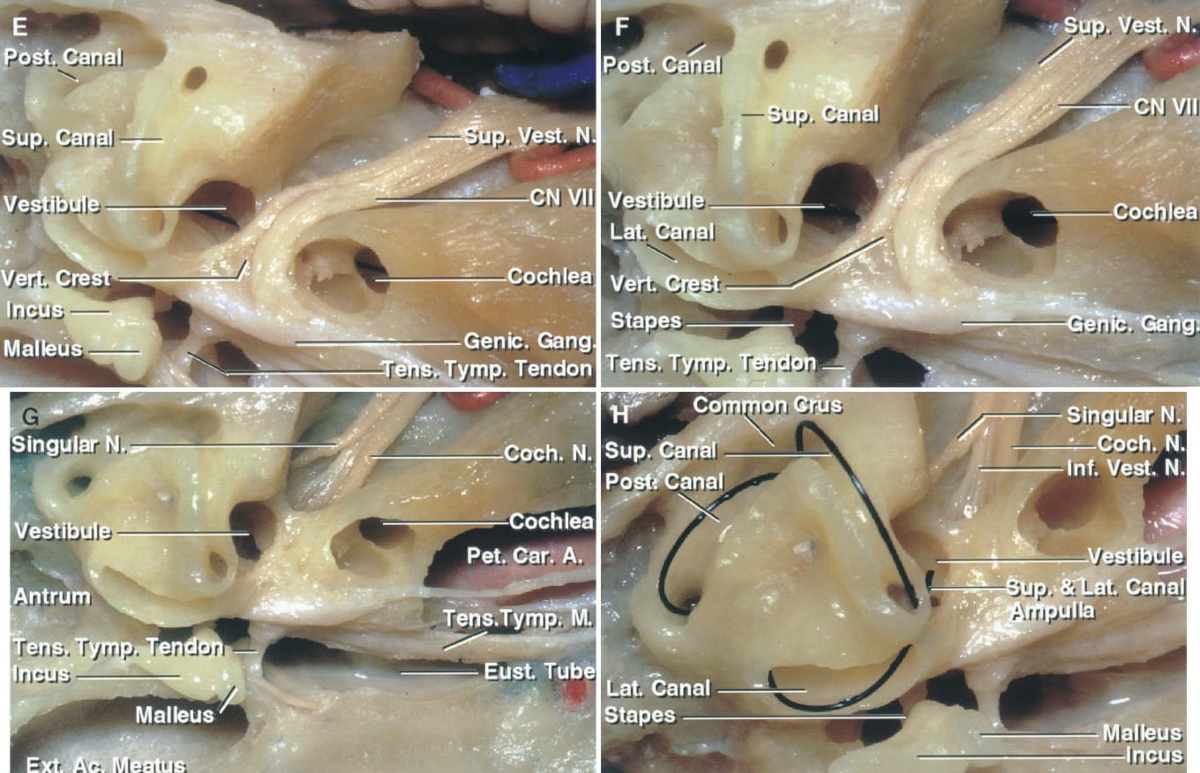 Middle Fossa Exposure of the Temporal Bone | Neuroanatomy | The ...