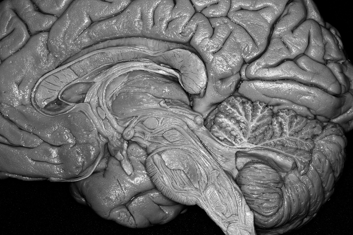 Midsagittal View of Dissected Brainstem, Cerebellum, and Deep Cerebrum ...