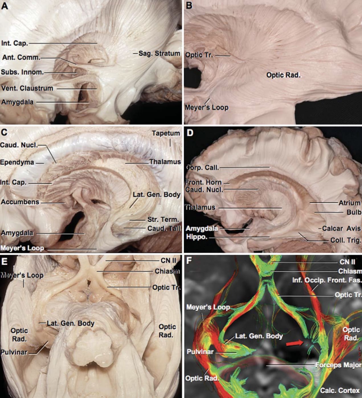 Optic Radiation | Neuroanatomy | The Neurosurgical Atlas