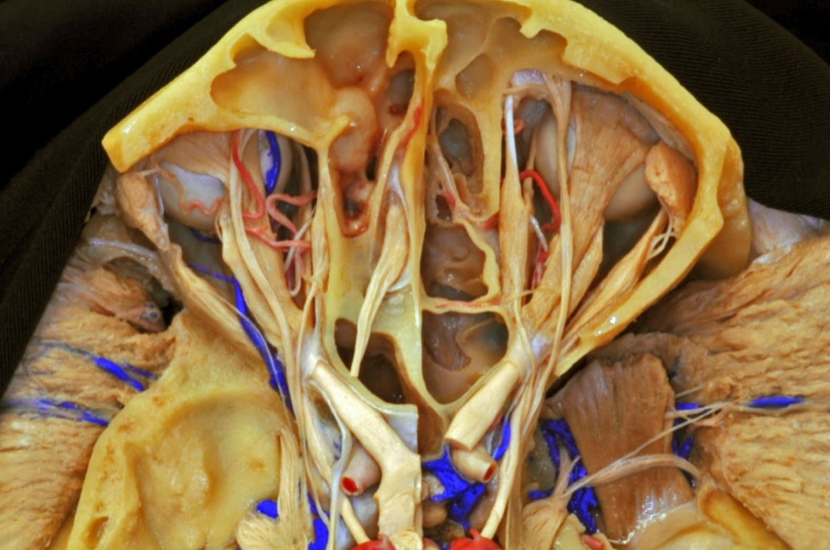 Panoramic Superior Views of Right and Left Orbits and Frontal, Ethmoid ...