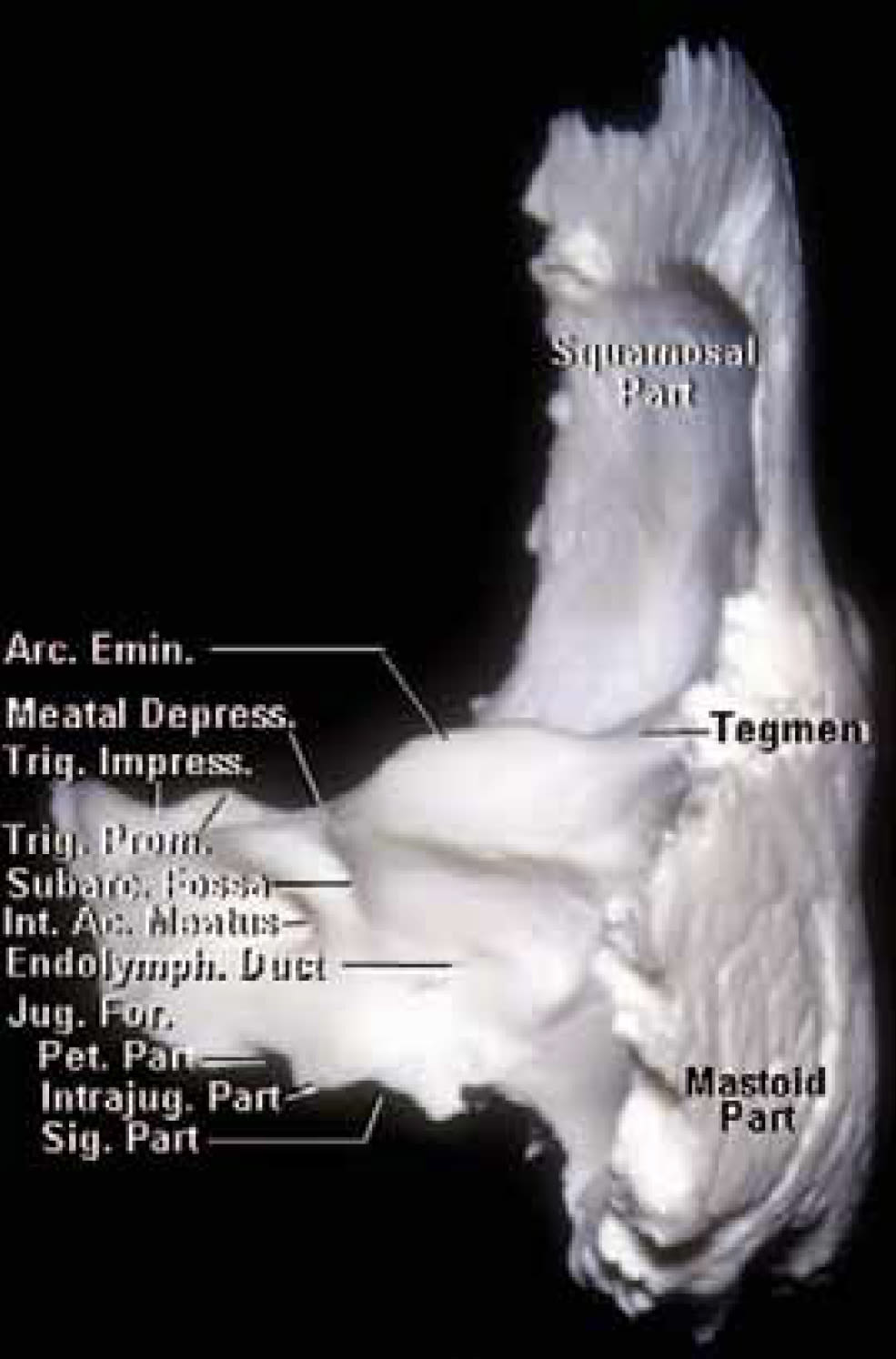 Posterior View of a Right Temporal Bone | Neuroanatomy | The ...