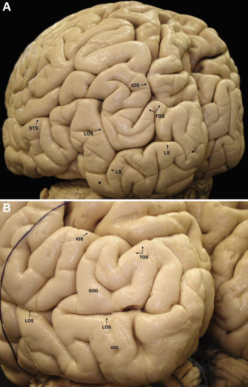 Posterior View of Another Left Hemisphere | Neuroanatomy | The ...