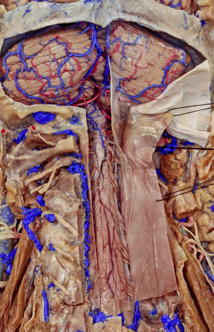Posterior View of Contents of the Posterior Cranial Fossa and Spinal ...